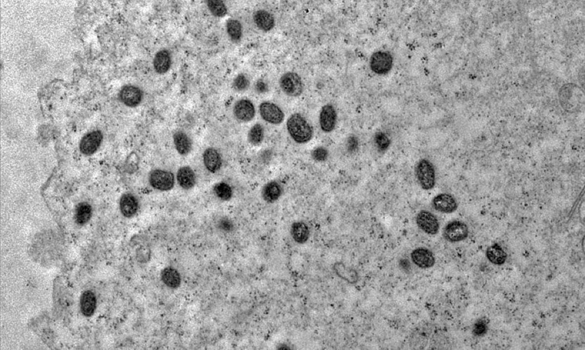 Mpox: São Paulo confirma segundo caso da doença pela nova cepa clado Ib ...